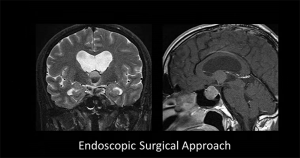 Endoscopic Colloid Cyst Surgery Adult Hydrocephalus Center