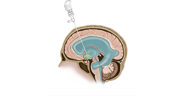 Endoscopic Third Ventriculostomy Adult Hydrocephalus Center