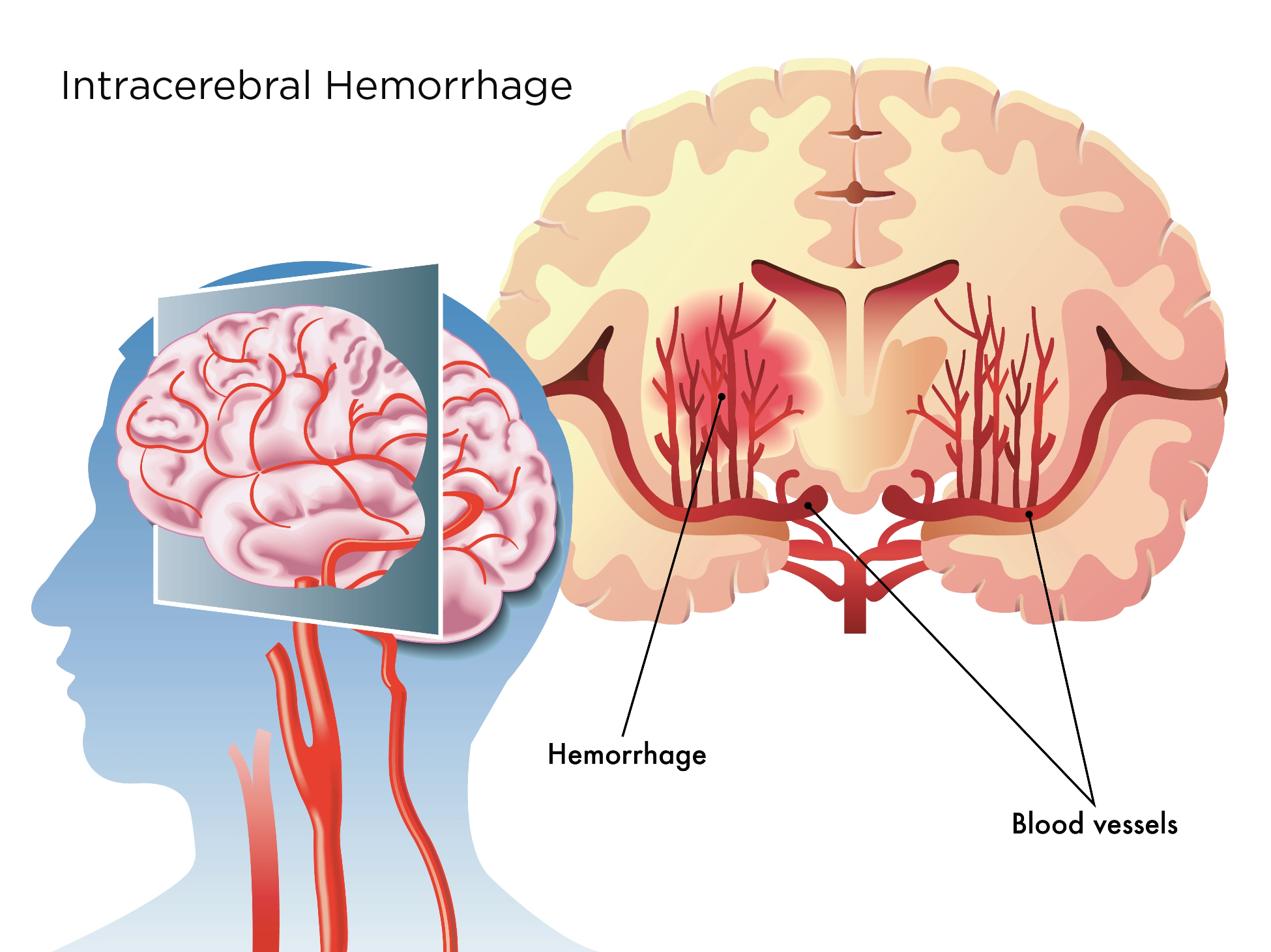 Intracerebral Hemorrhage Symptoms Treatment Stroke Aneurysm Center