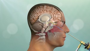 Minimally Invasive Brain Surgery | Keyhole Craniotomy | Pacific Brain Tumor Center