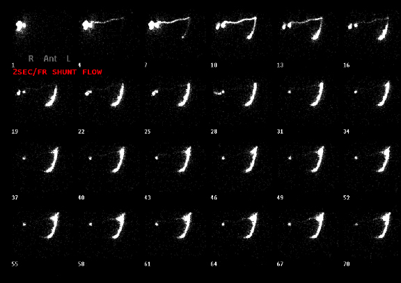 Shuntogram Test for Shunt Function | Adult Hydrocephalus Center