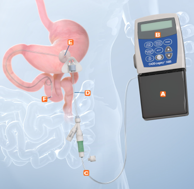 Duopa Treatment for Parkinson's Disease | Movement Disorders