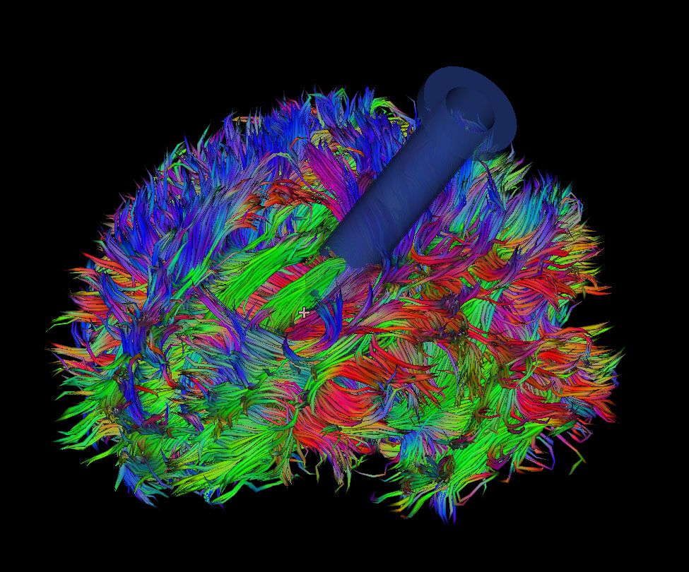 Brain Port Neurosurgery Approach | Pacific Brain Tumor Center