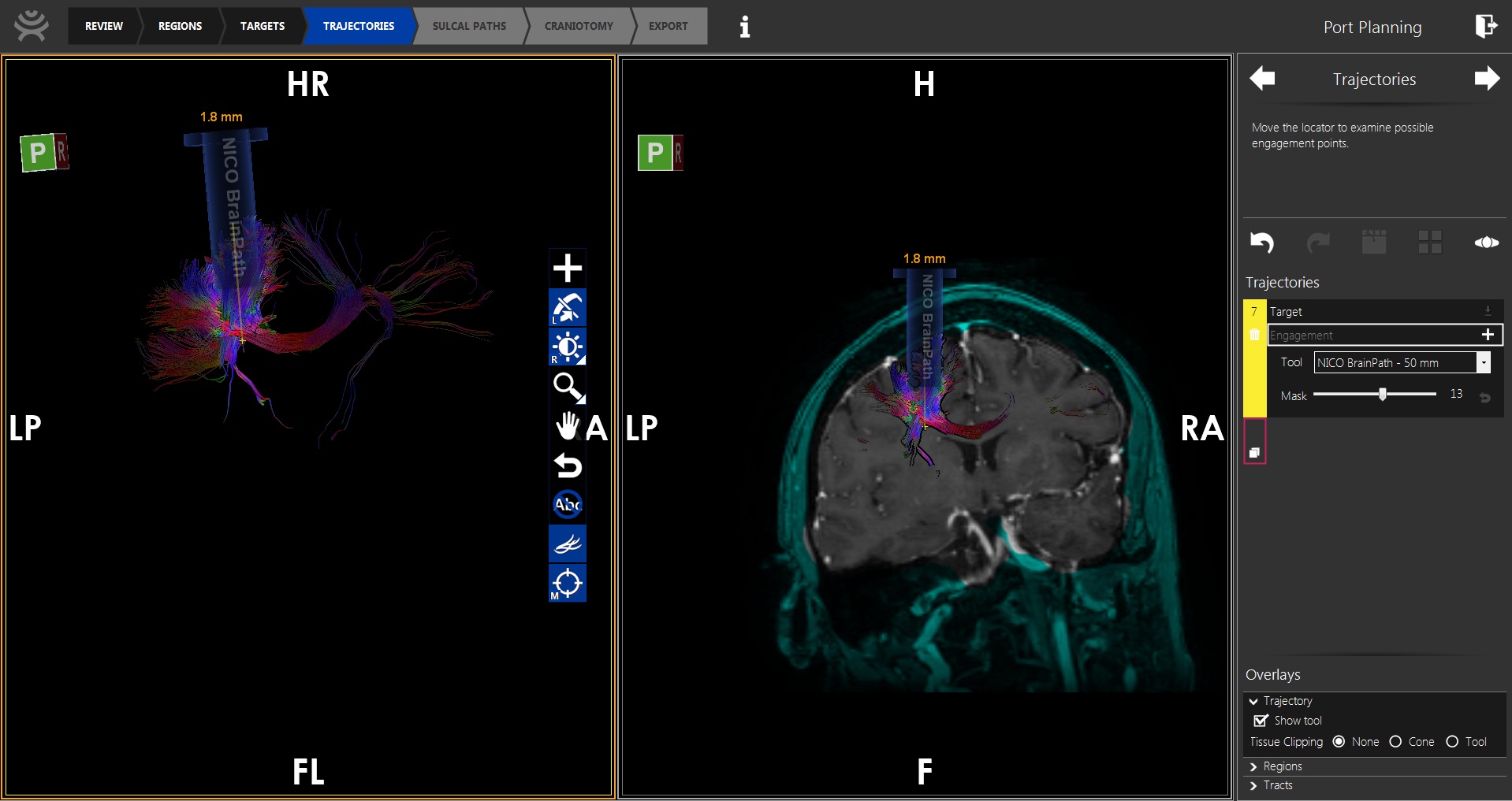 Brain Port Neurosurgery Approach | Pacific Brain Tumor Center