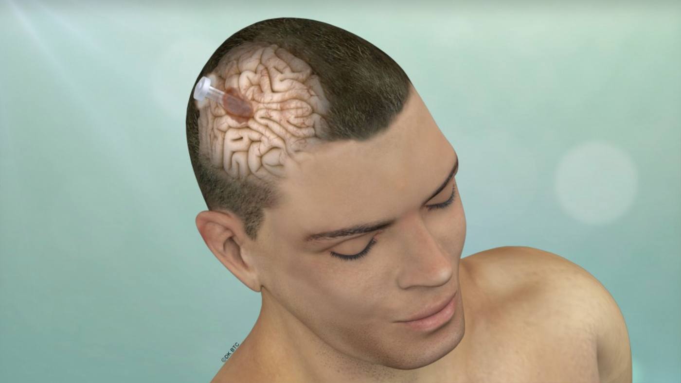 Minimally Invasive Brain Surgery | Keyhole Craniotomy | Pacific Brain Tumor Center