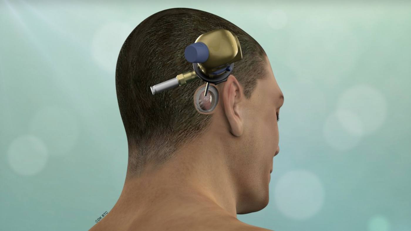 Minimally Invasive Brain Surgery | Keyhole Craniotomy | Pacific Brain ...