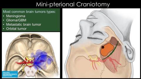 Minimally Invasive Brain Surgery | Keyhole Craniotomy | Pacific Brain ...