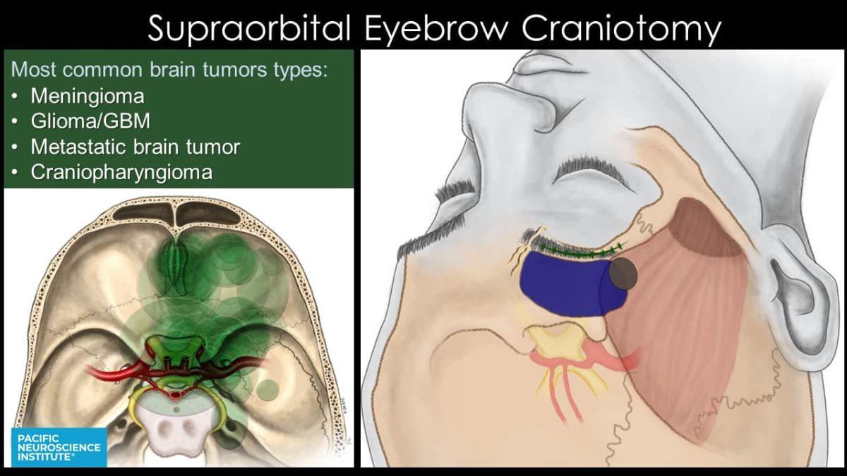 Minimally Invasive Brain Surgery | Keyhole Craniotomy | Pacific Brain Tumor Center