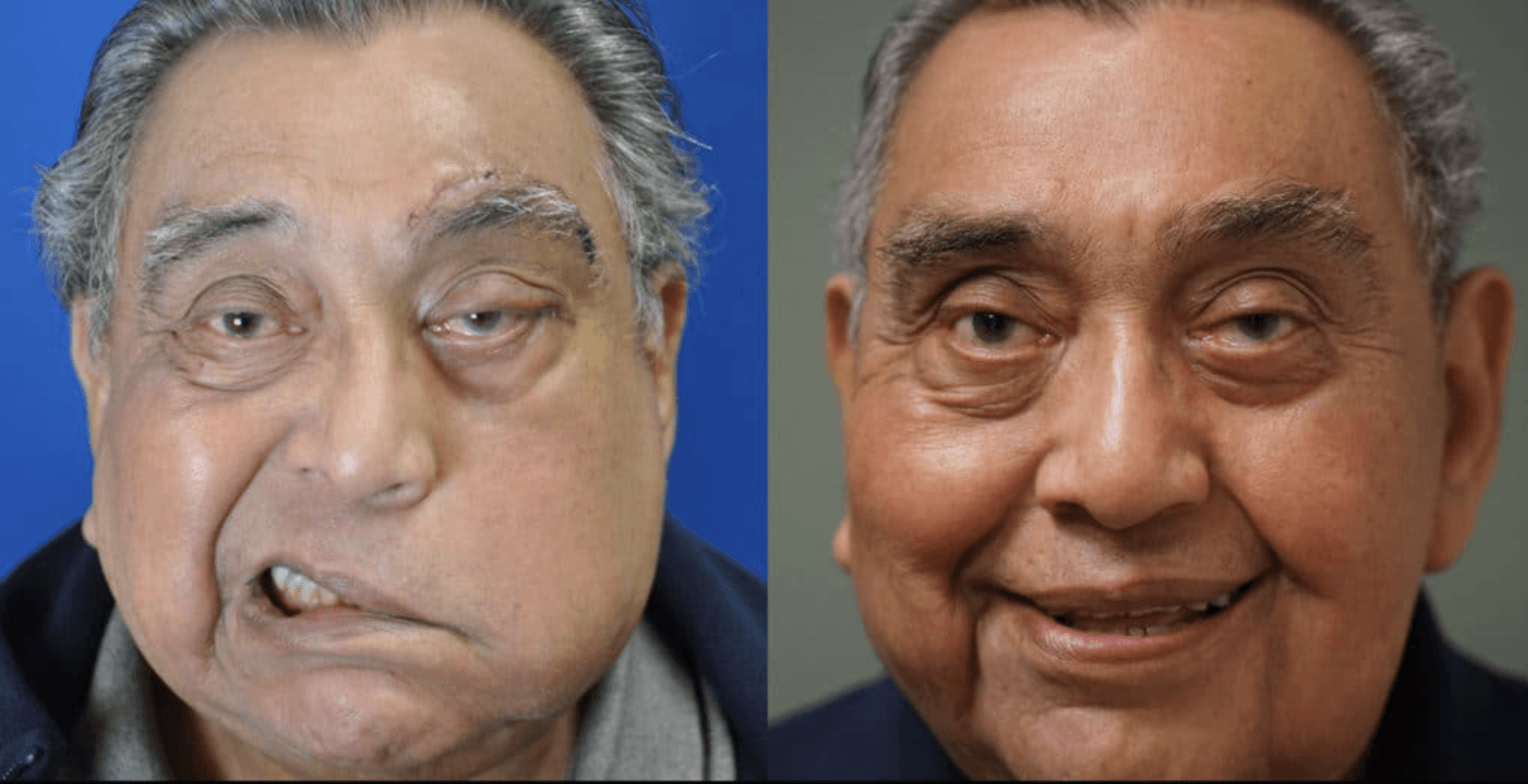 Facial Reanimation Surgery - Pacific Eye & Ear