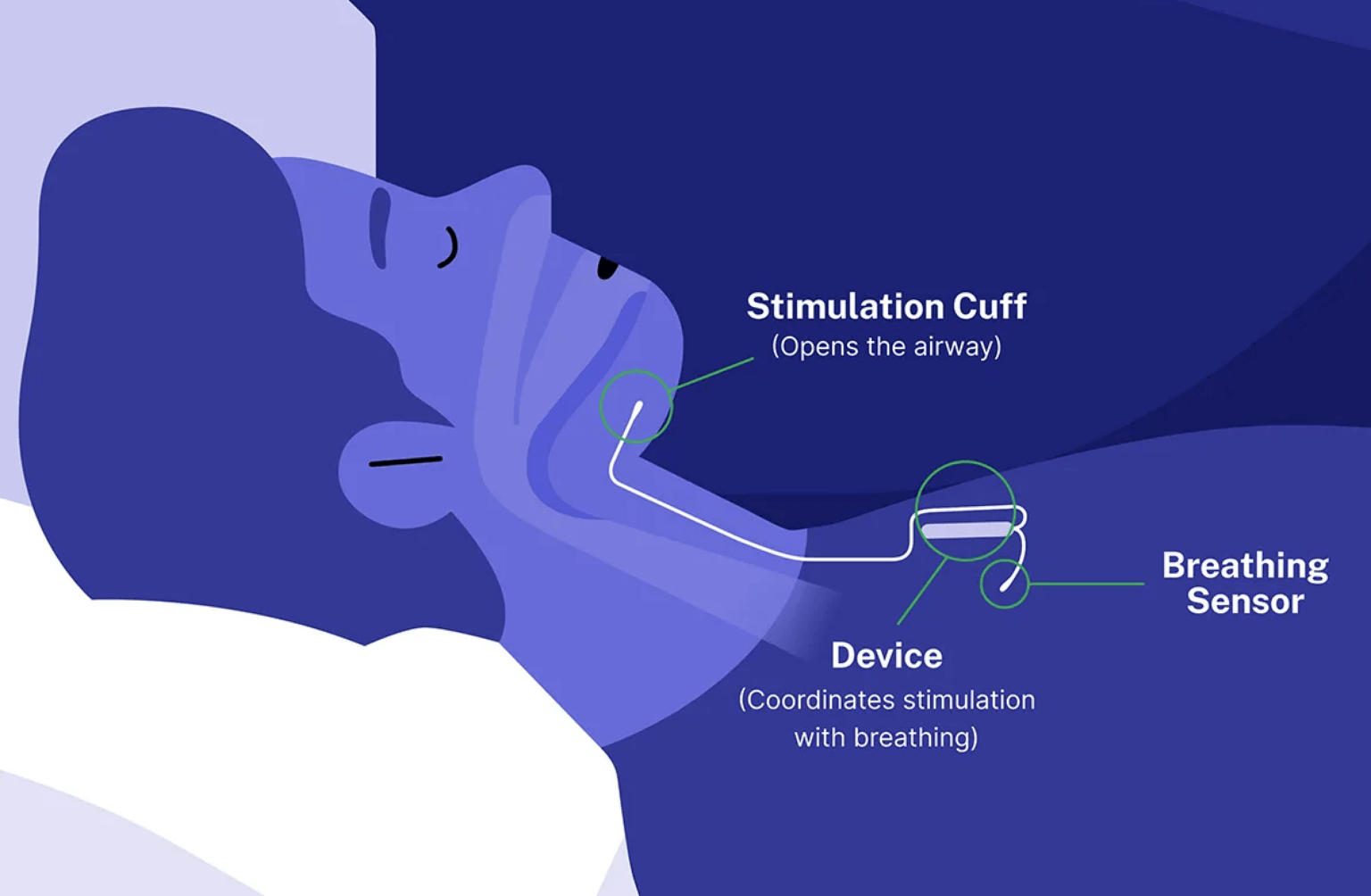 Surgery for Sleep Apnea | Obstructive Sleep Apnea Surgery
