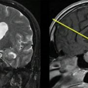 Colloid Cyst Information & Symptoms | Pacific Adult Hydrocephalus Center