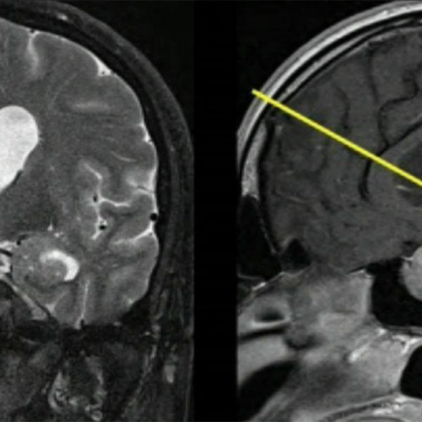 Colloid Cyst Information & Symptoms | Pacific Adult Hydrocephalus Center