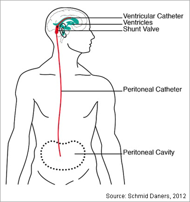 Ventriculoperitonial Shunt | Pacific Adult Hydrocephalus Center
