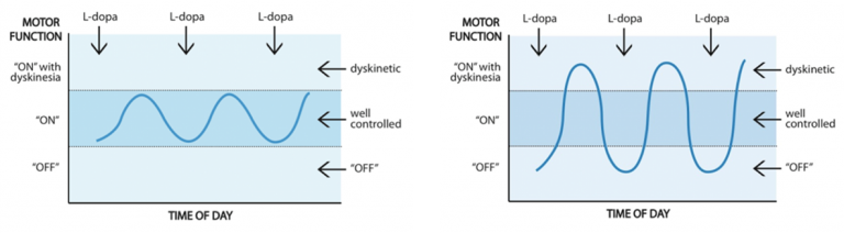 Duopa Treatment for Parkinson's Disease | Pacific Movement Disorders