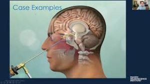 Endoscopic Endonasal Procedures | Pacific Pituitary Disorders Center