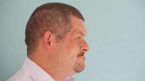 Acromegaly Disease Symptoms, Diagnosis and Treatment | PNI