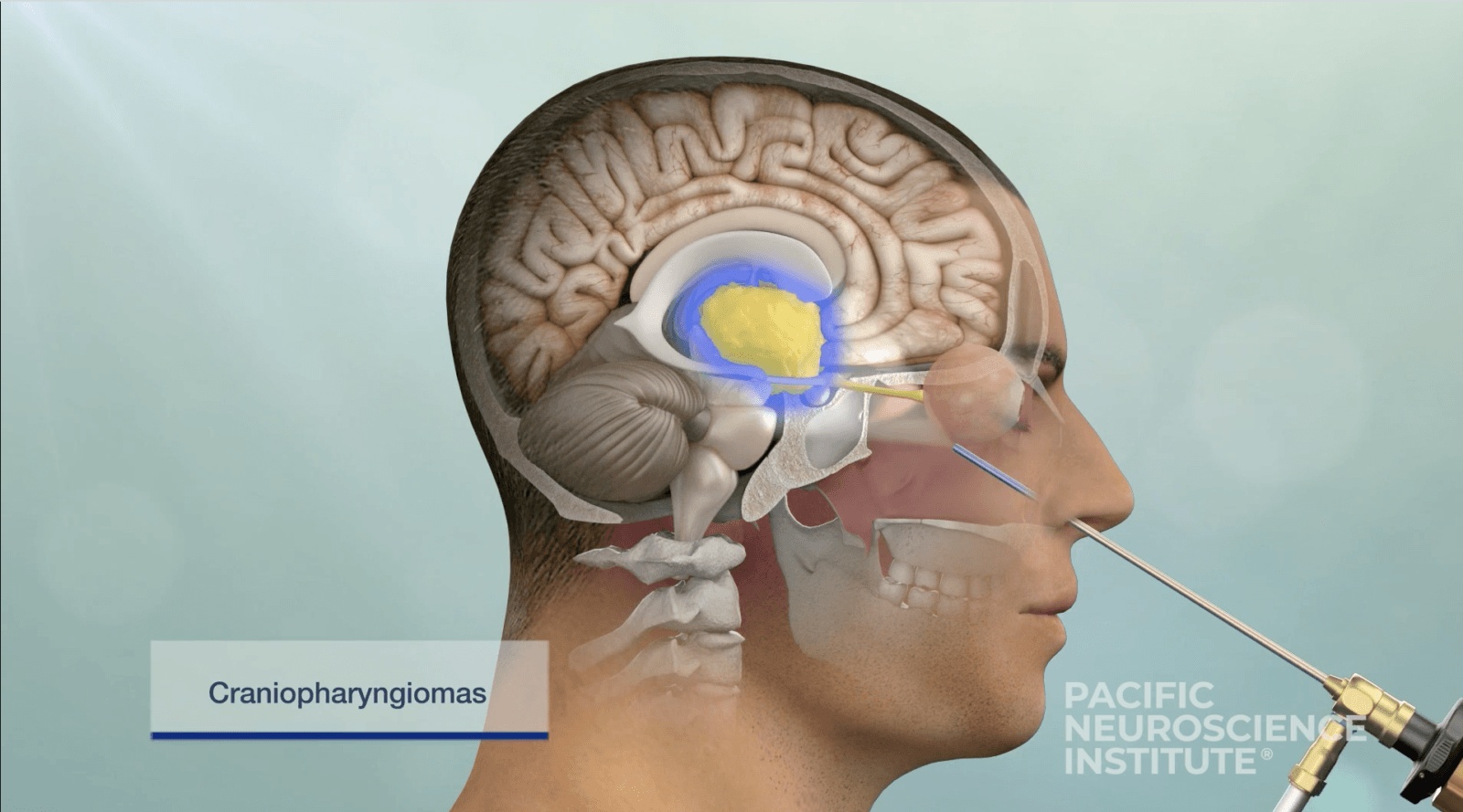 Intracranial Meningioma, The Common Brain Tumor | Pacific Neuroscience Institute