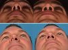 Is Your Nose Bent Out Of Shape? Maybe It's A Deviated Nasal Septum ...