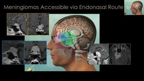The Many Manifestations of Meningiomas | Pacific Neuroscience Institute