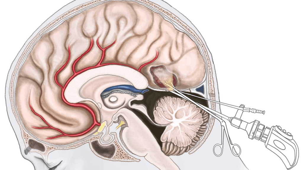 Keyhole Procedure Videos - Pacific Neuroscience Institute