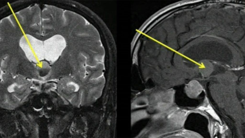 Adult Hydrocephalus Center Videos Pacific Neuroscience Institute