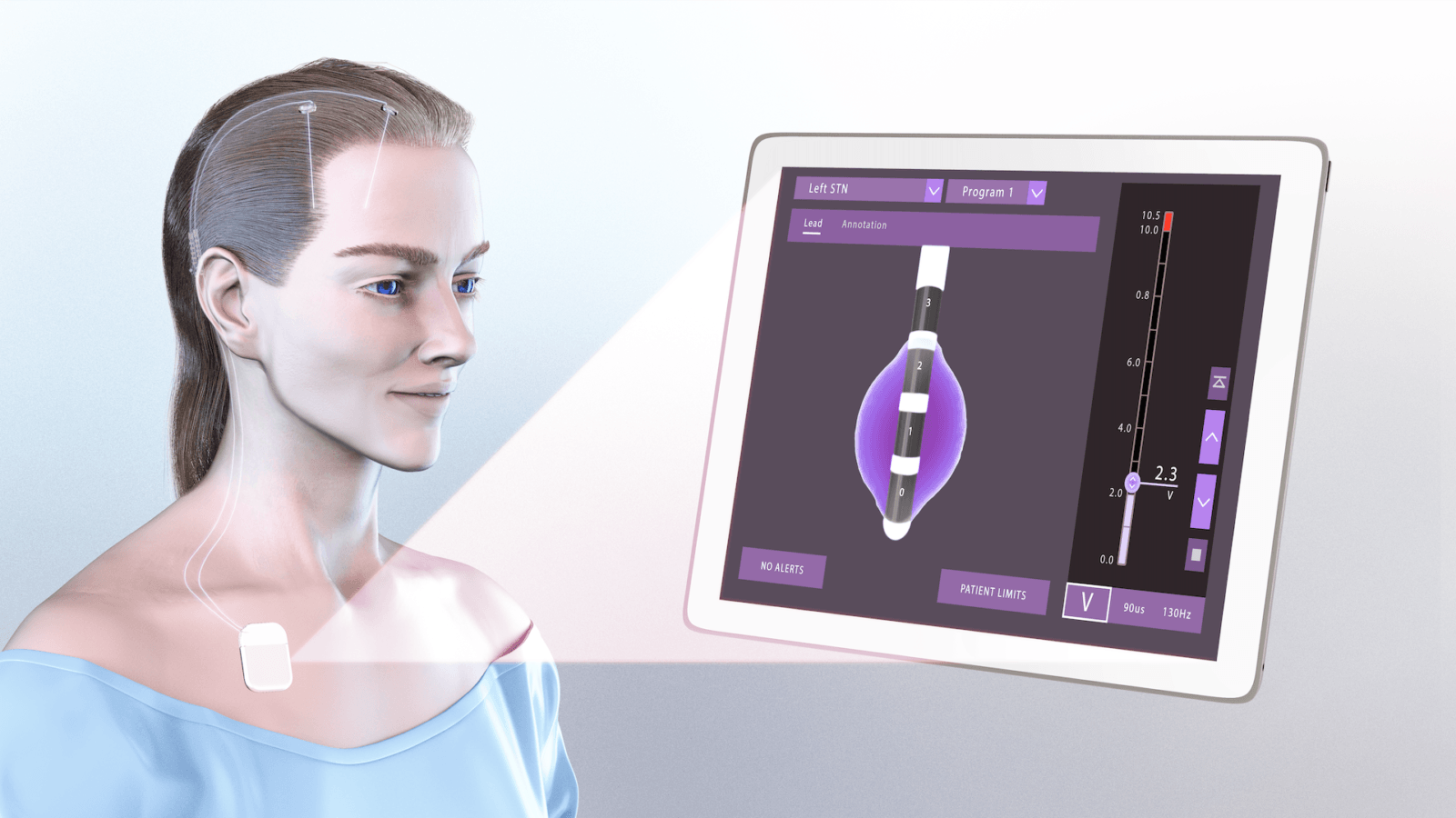 What Can I Expect With Deep Brain Stimulation (DBS) Surgery?