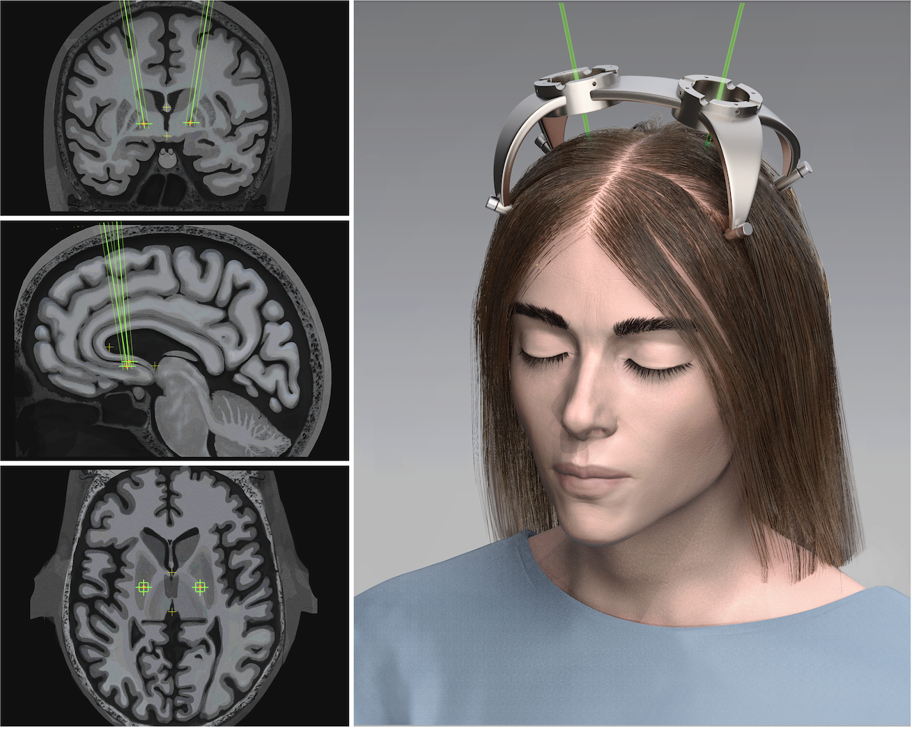 What Can I Expect With Deep Brain Stimulation (DBS) Surgery?