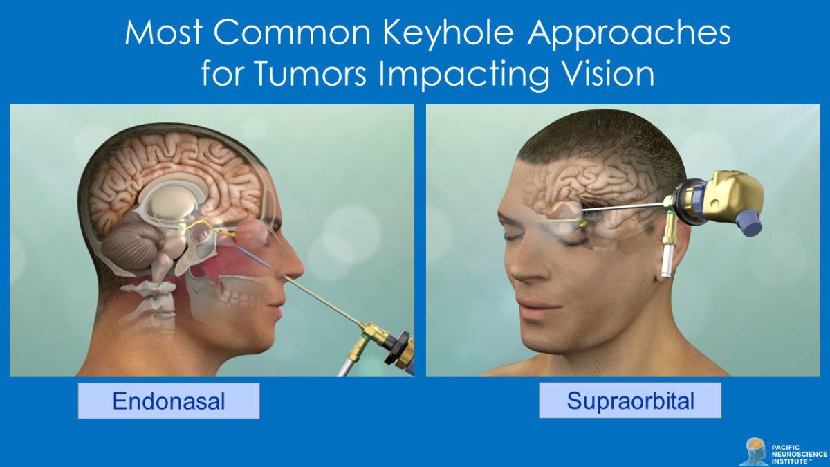 I Can See Clearly Now The Tumor’s Gone | Pacific Neuroscience Institute