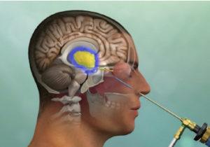 Meningioma Surgery in Older Patients Has High Rate of Success - Pacific Neuroscience Institute