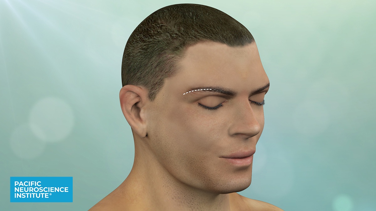 Brain Surgery Through the Eyebrow - Pacific Neuroscience Institute